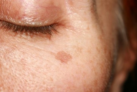 Routine contre l’hyperpigmentation de la peau et les taches brunes dues ...
