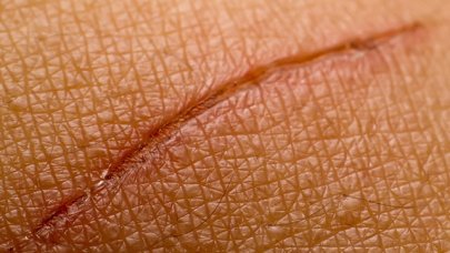 Coupure, écorchure, cicatrice…les bons réflexes pour accélérer la ...